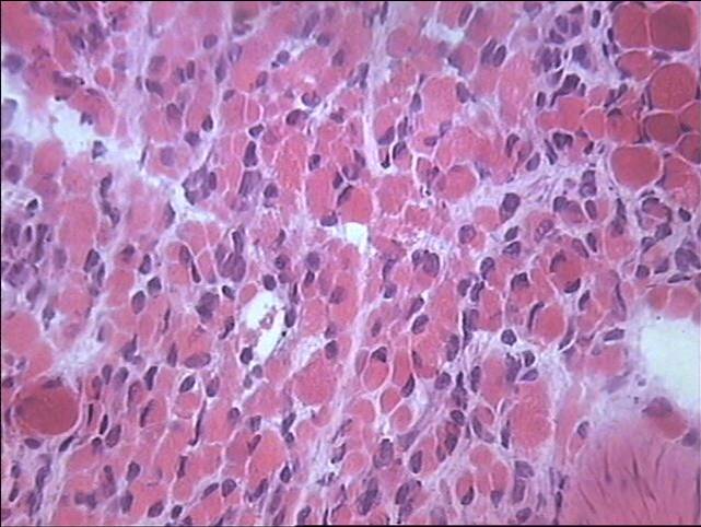 ATROFIA MUSCULAR PROGRESIVA - Binipatia e higienismo