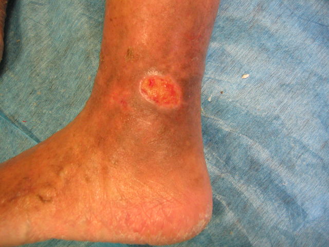 ÚLCERA VARICOSA - Binipatia e higienismo