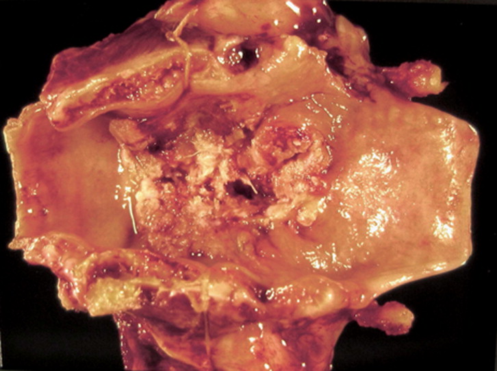 CÁNCER DE FARINGE - Binipatia e higienismo