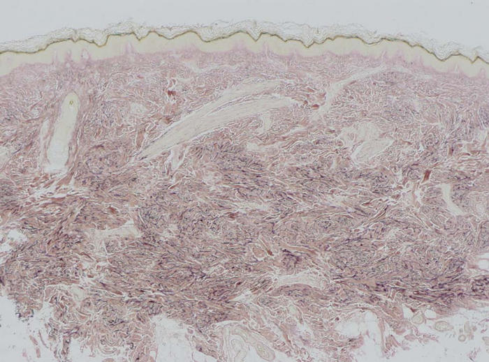 ANETODERMIA - Binipatia e higienismo
