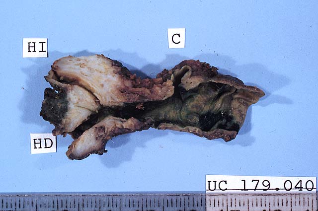 Neoplasias Dos Ductos Biliares; Câncer dos Ductos Biliares; Câncer do ...