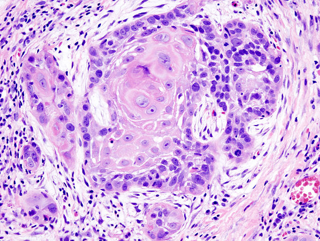 CARCINOMA DE AMIGDALAS - Binipatia e higienismo