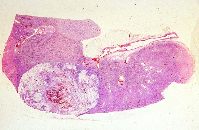 ADIPOSIS DOLOROSA - Binipatia e higienismo