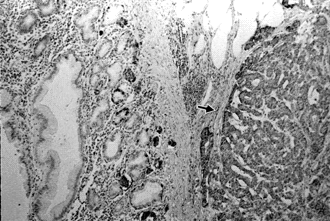 COREOATETOSIS - Binipatia e higienismo