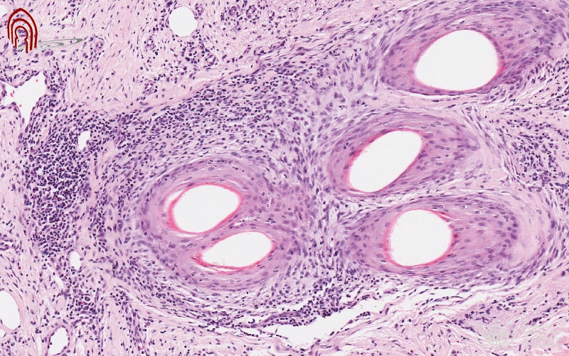 CONDILOMA ACUMINADO - Binipatia e higienismo