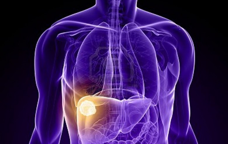 CÁNCER HEPÁTICO - Binipatia e higienismo