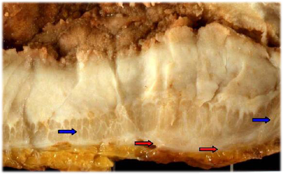 ANETODERMIA - Binipatia e higienismo