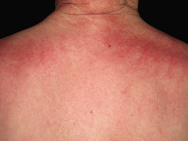 DERMATOMIOSITIS - Binipatia e higienismo