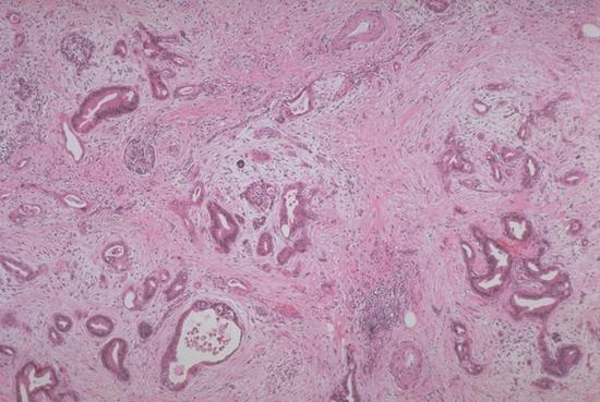 CANCROIDE - Binipatia e higienismo