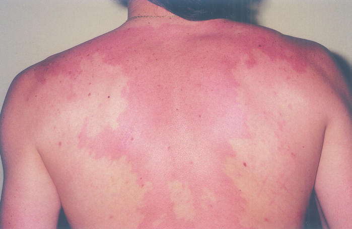 MÁCULA - Binipatia e higienismo