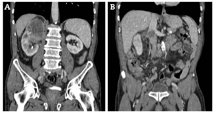 CARCINOMA DE CÉLULAS TRANSICIONALES EN PELVIS - Binipatia e higienismo