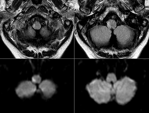 SÍNDROME BULBAR LATERAL - Binipatia e higienismo