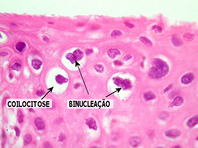 CONDILOMA PLANO - Binipatia e higienismo