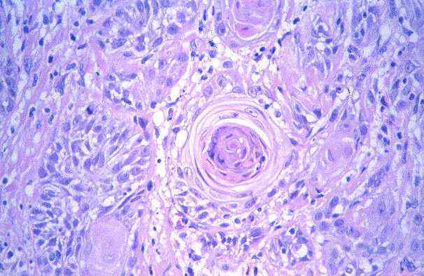 CARCINOMA EPIDERMOIDE - Binipatia e higienismo