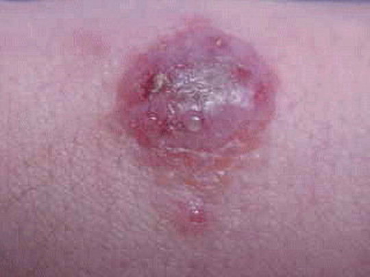 ECTIMA - Binipatia e higienismo