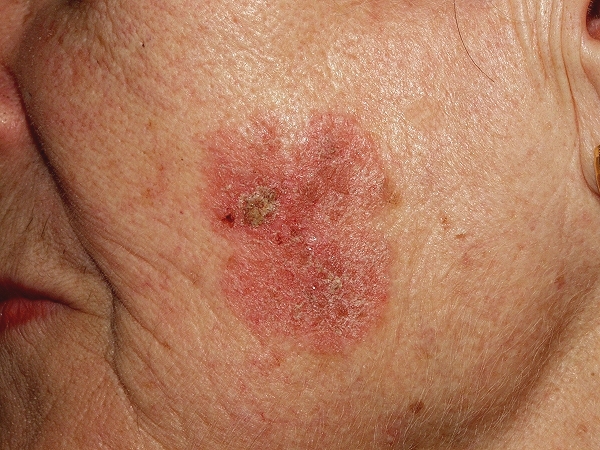 ENFERMEDAD DE BOWEN - Binipatia e higienismo