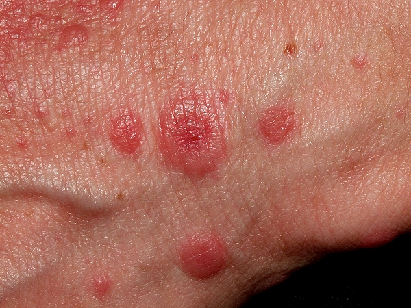 ERITEMA EXUDATIVO MULTIFORME DE HEBRA - Binipatia e higienismo