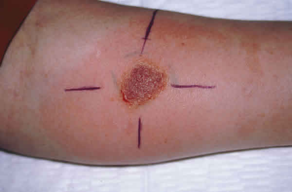 DERMATÓLISIS - Binipatia e higienismo