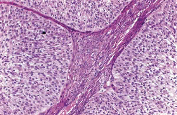CARCINOMA DE CÉLULAS TRANSICIONALES EN EL URÉTER - Binipatia e higienismo