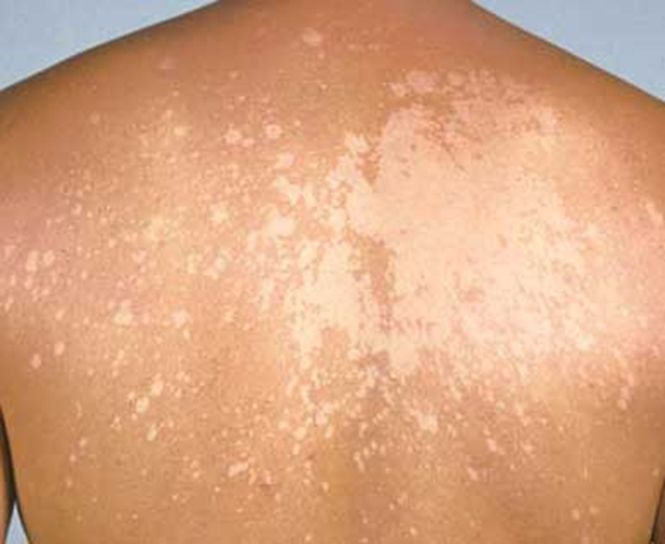 DERMATOMICOSIS - Binipatia e higienismo