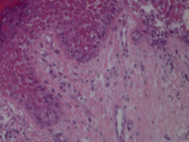 LEUCOPLASIA MALIGNA DE LA MUCOSA ORAL - Binipatia e higienismo
