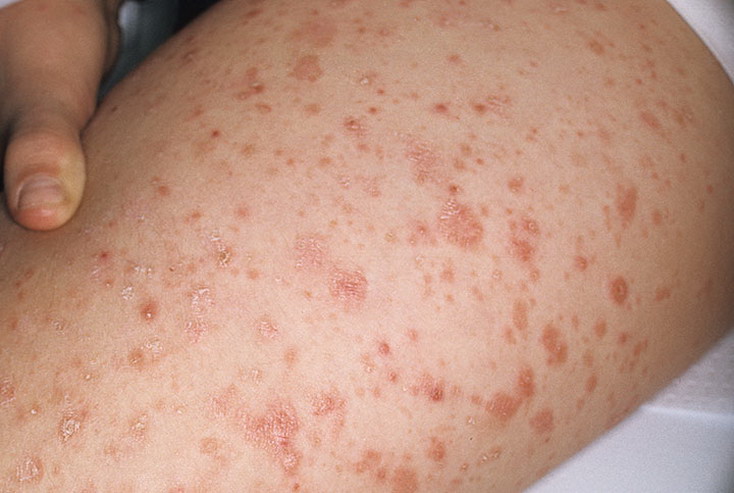 PARAPSORIASIS - Binipatia e higienismo