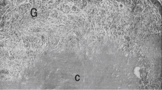 ANETODERMIA ERITEMATOSA DE JADASSOHN - Binipatia e higienismo