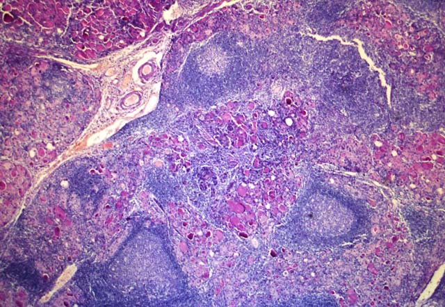 ABSCESOS SEBÁCEOS - Binipatia e higienismo