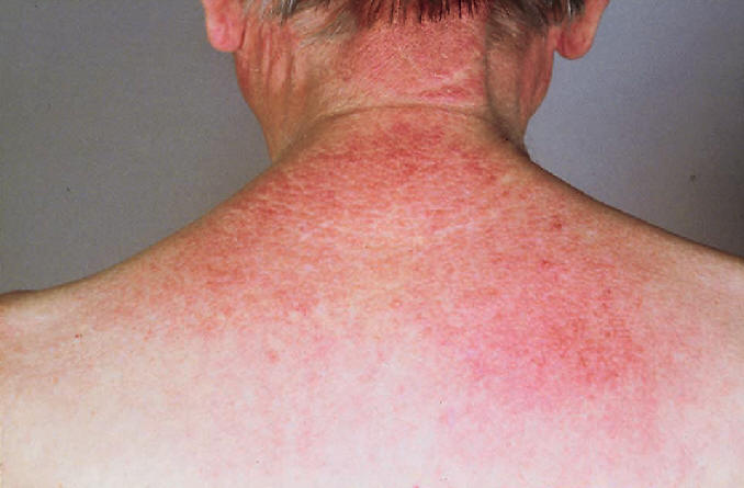 POIQUILODERMIA - Binipatia e higienismo