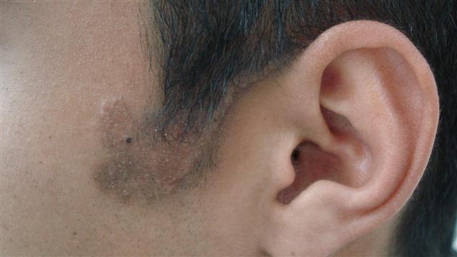 NEVUS SEBÁCEO DE JADASSOHN - Binipatia e higienismo