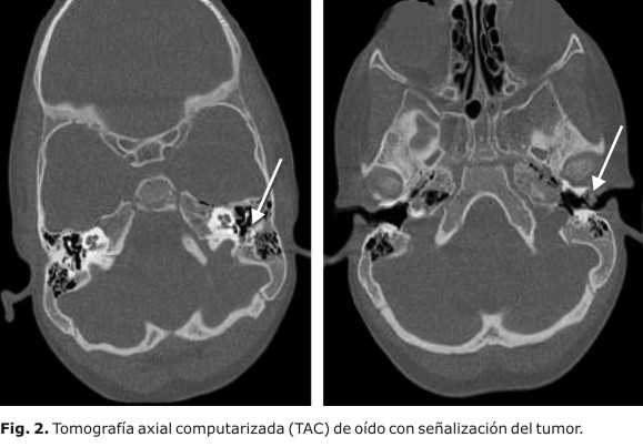 TUMOR PRIMARIO MALIGNO DEL OIDO MEDIO - Binipatia e higienismo