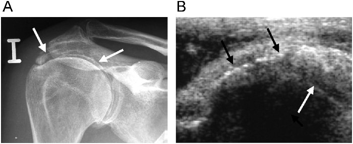 CONDROCALCINOSIS - Binipatia e higienismo