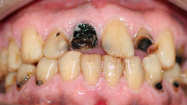 CARIES DENTAL - Binipatia e higienismo