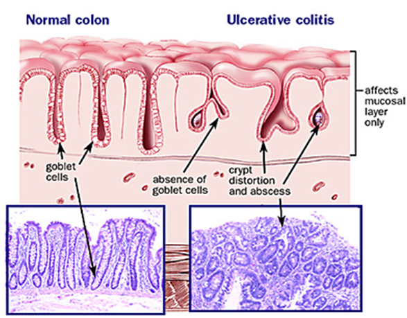 COLITIS ULCEROSA - Binipatia e higienismo