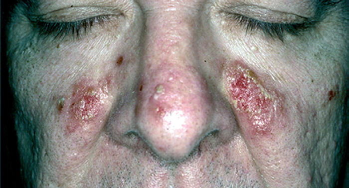 PÉNFIGO - Binipatia e higienismo