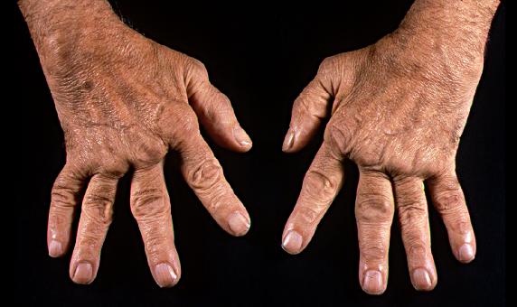 Artritis Reumatoide Sero Negative Rheumatoid Arthritis - letterserver
