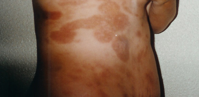 ESCLERODERMIA SISTEMICA - Binipatia e higienismo