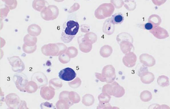 ANEMIA DE COOLEY - Binipatia e higienismo